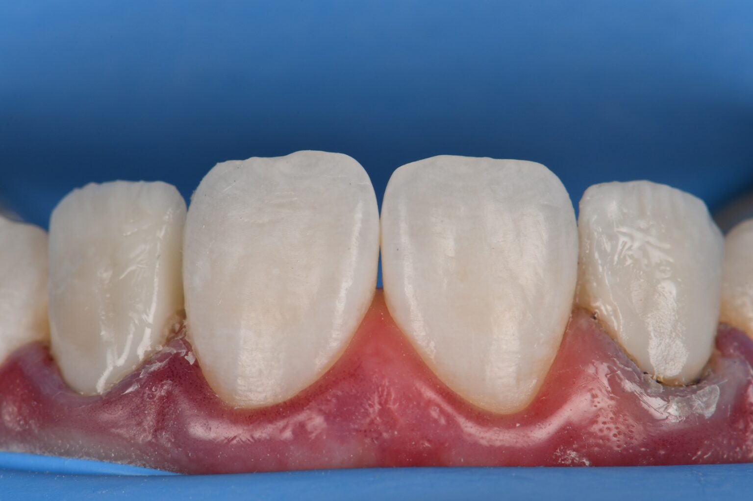 Composite Veneers to correct peg laterals with Layering and Effects
