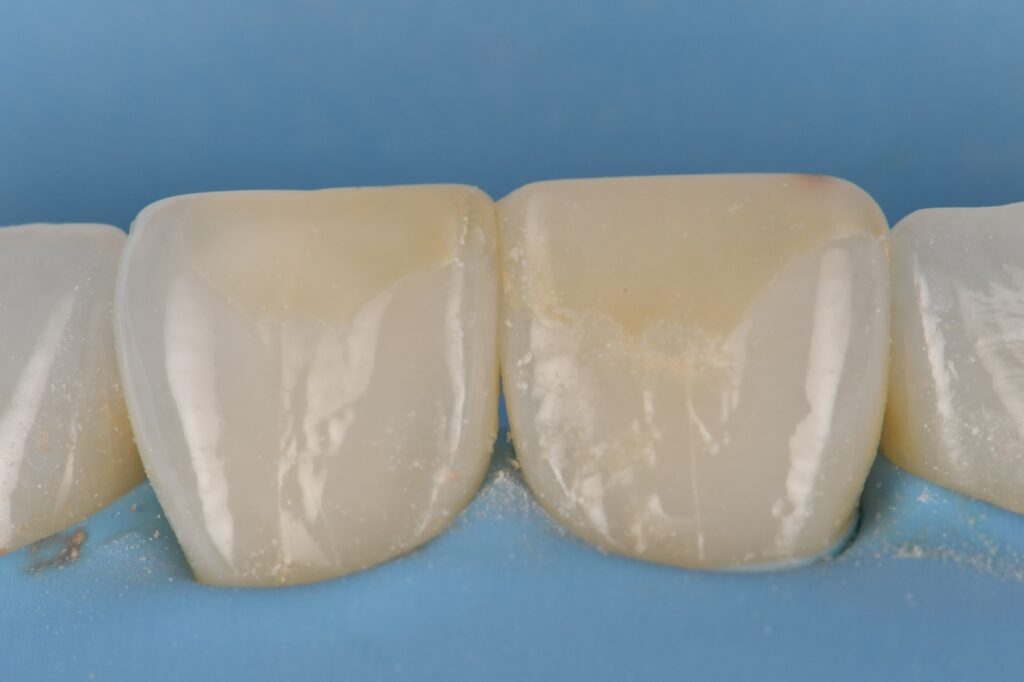 Voco Amaris Composite Veneers