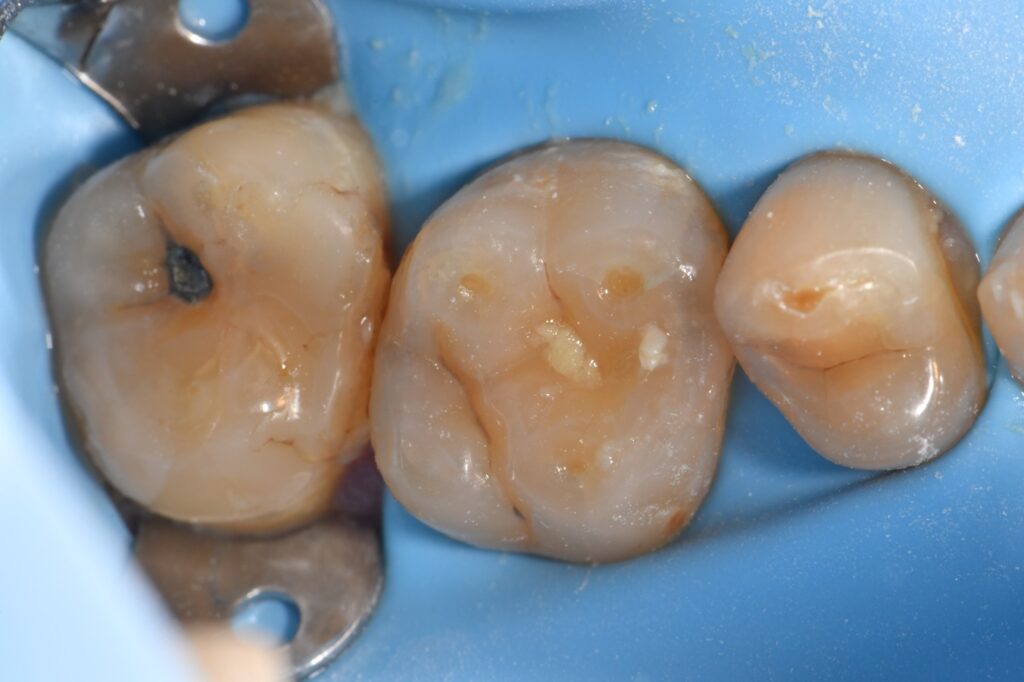 Clampless DME in a complex composite restoration