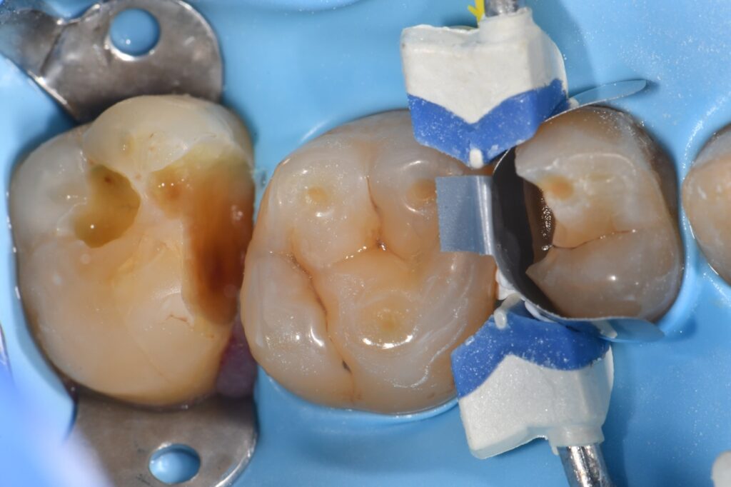 Clampless DME in a complex composite restoration