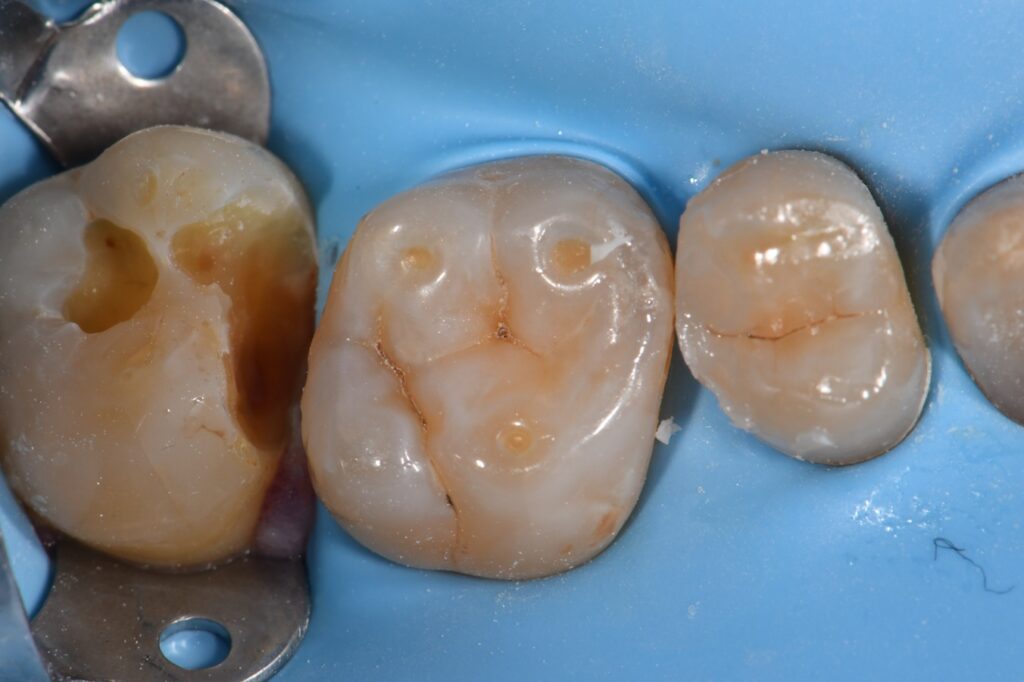 Clampless DME in a complex composite restoration