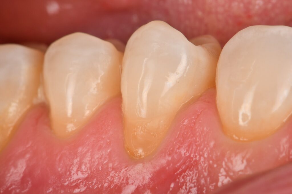 Cervical abrasion Class 5 banger restoration