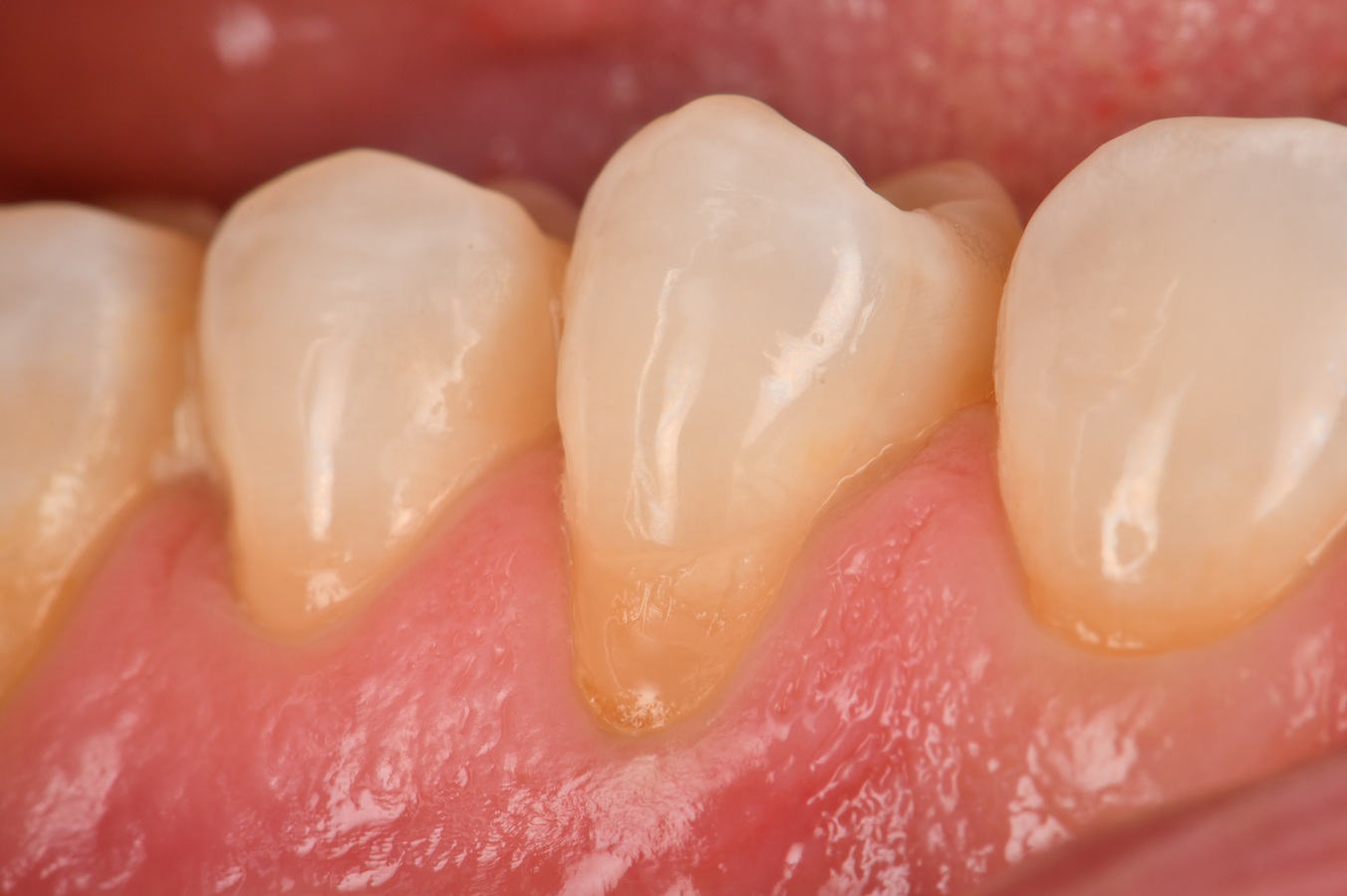 Cervical abrasion Class 5 banger restoration