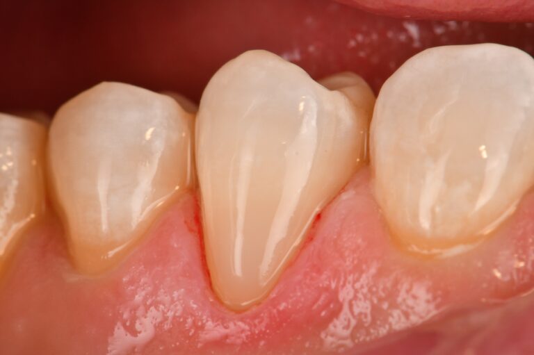 Cervical abrasion Class 5 banger restoration