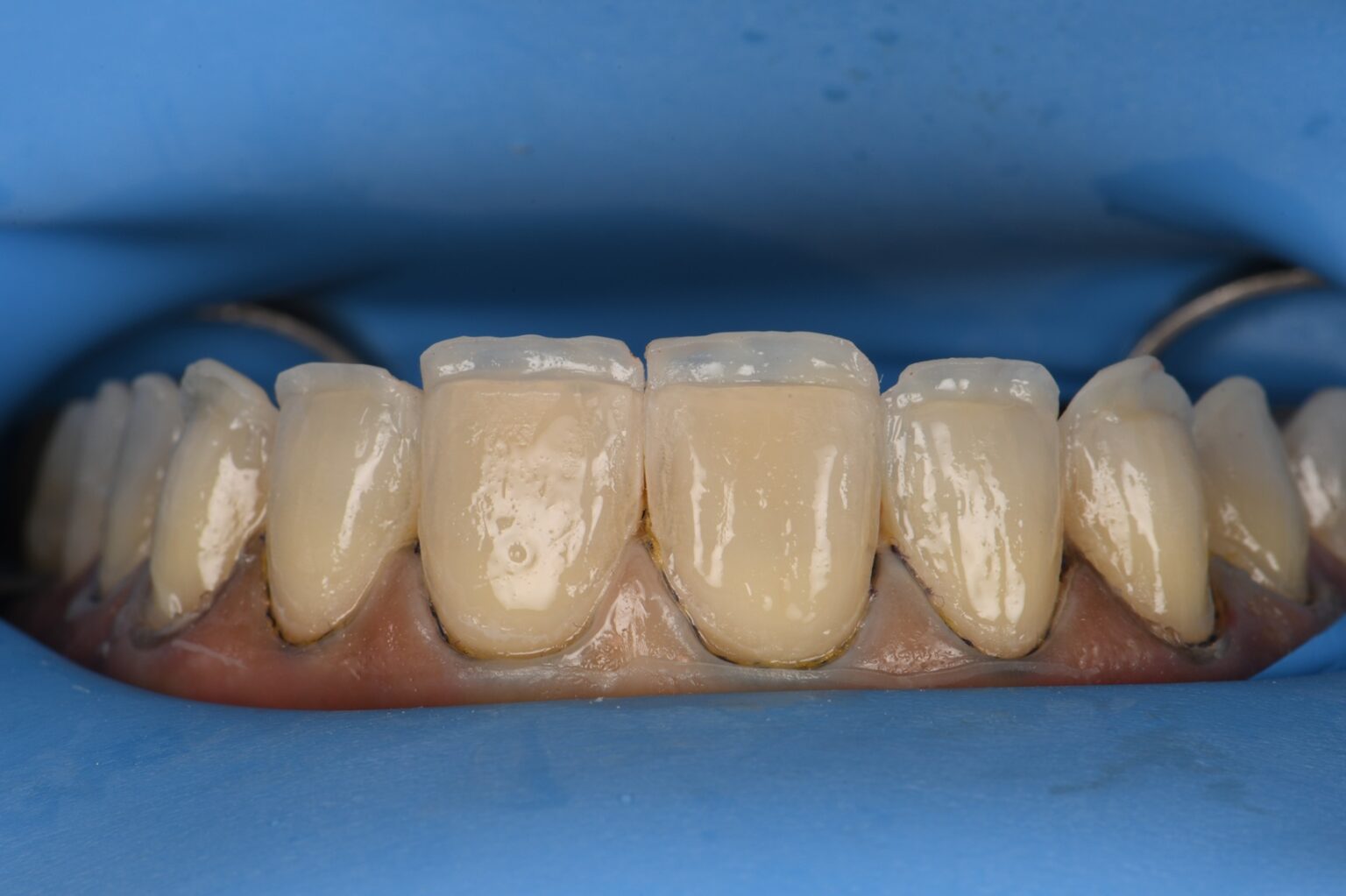 Patient participation in Smile Design with Composite Veneers